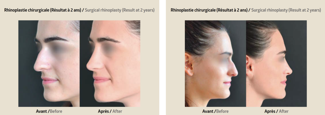 Rhinoplastie anatomique conservatrice : techniques et bénéfices - Anti ...