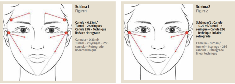 La polycaprolactone, inducteur fluide, nouvelle technique d’injection ...