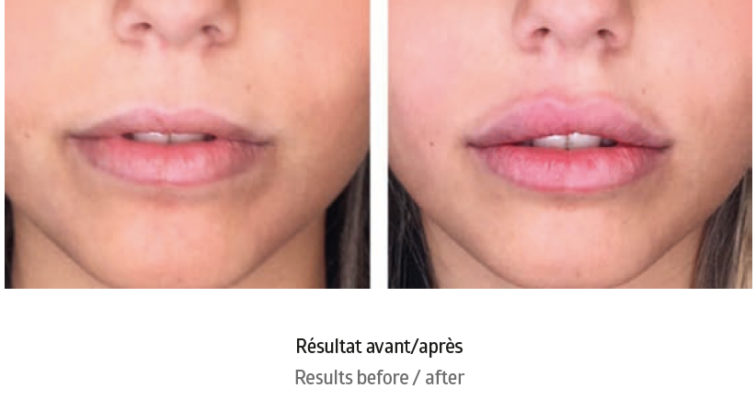 Augmentation du volume des lèvres : savoir jongler avec les lobes est ...